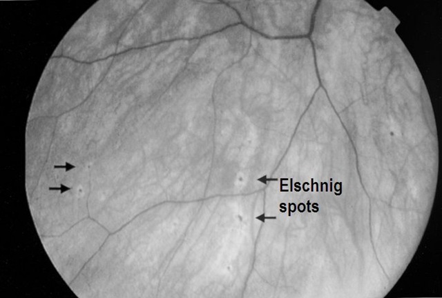 Medicine Decoded: Eponyms about Elschnig in Ophthalmology